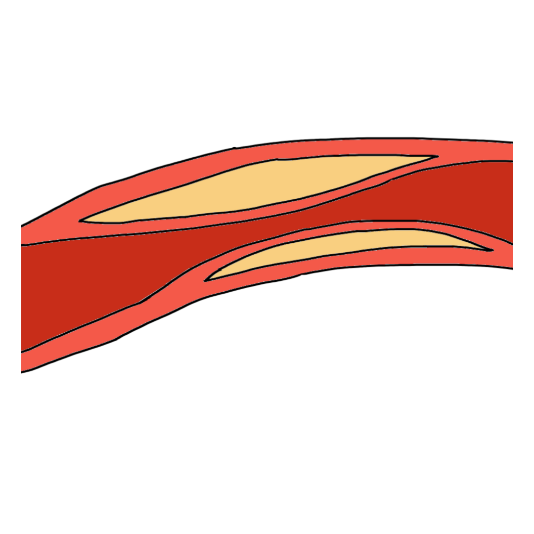 Atherosclerose – Biojuf