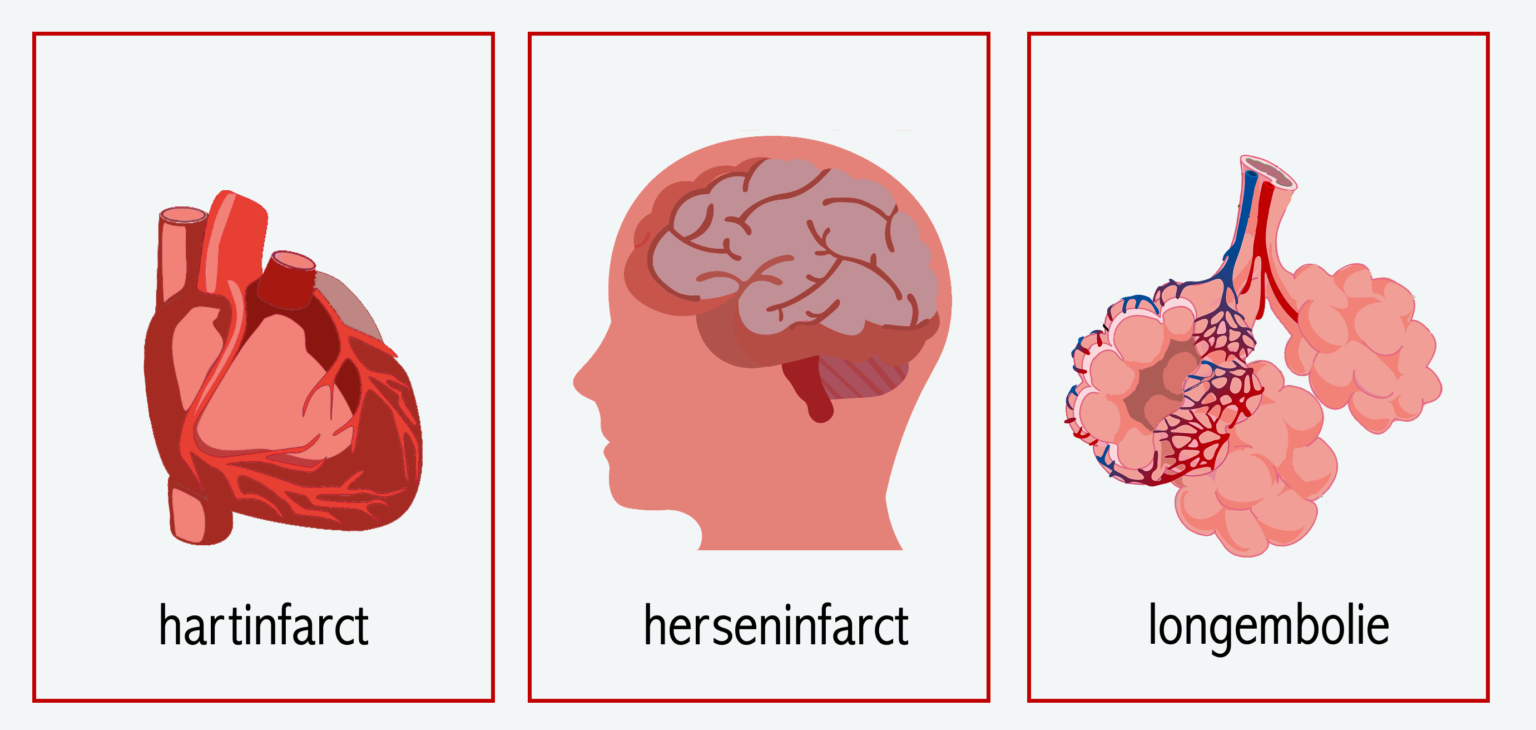 Atherosclerose – Biojuf